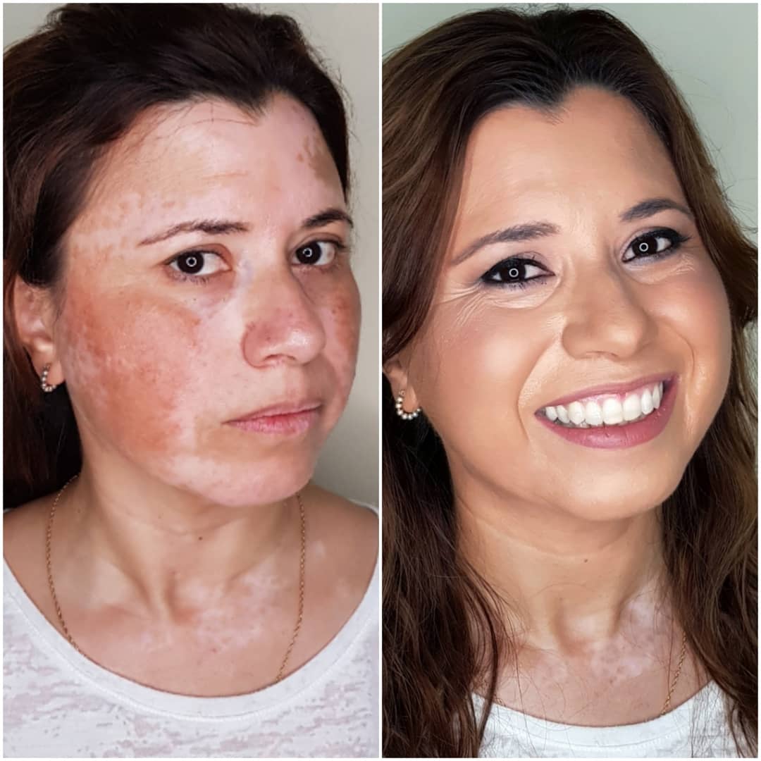 Vitiligo: La enfermedad de las manchas blancas - InformandoSalud