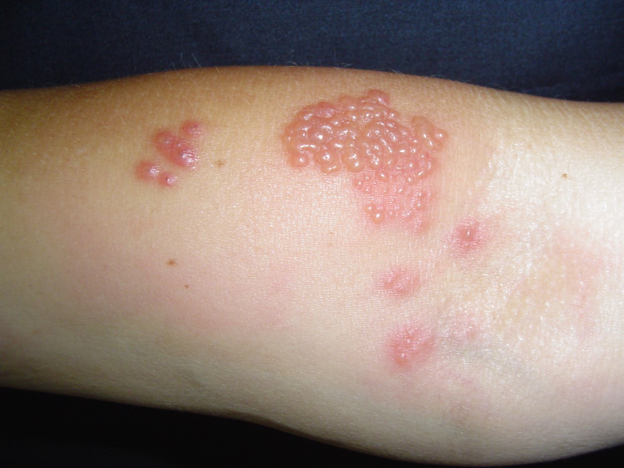 Herpes zóster o culebrilla: Causas, síntomas y tratamiento ...