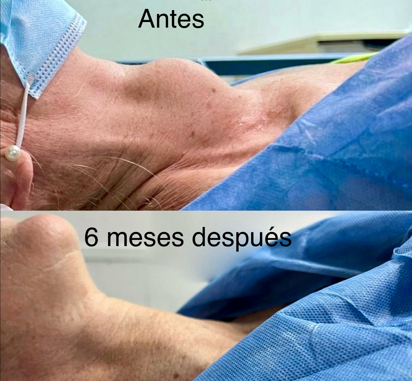 Nódulos de tiroides: Ablación por radiofrecuencia que evita la cirugía ...