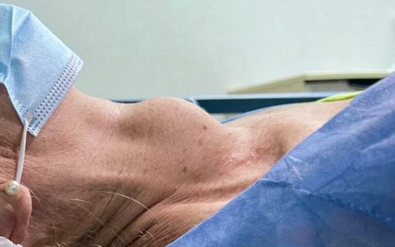 Nódulos de tiroides: Ablación por radiofrecuencia que evita la cirugía ...